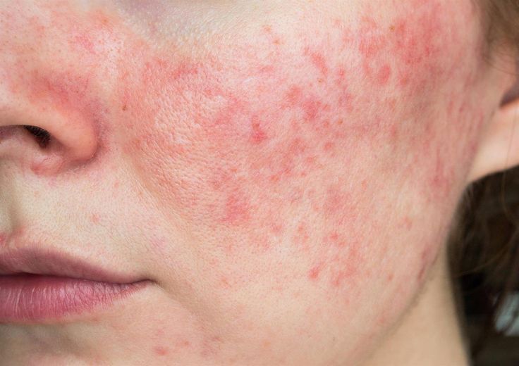 Dermatitis - Circle Care Clinic